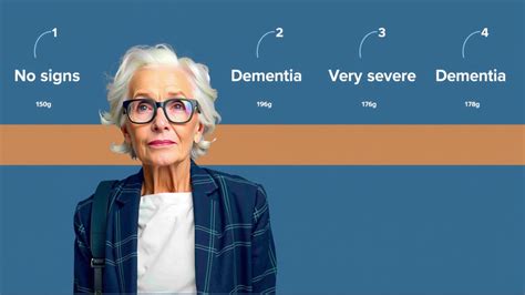 The Seven Stages Of Dementia Using The Global Deterioration Scale Gds