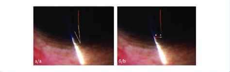 Estimation Of Peripheral Anterior Chamber Depth Acd Peripheral