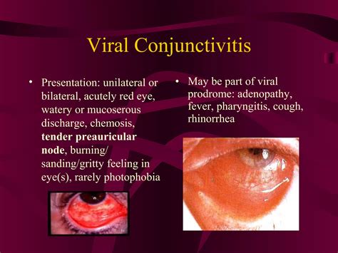 Conjunctivitis Ppt