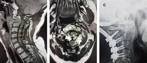 Follicular Thyroid Carcinoma Metastasis In The Axis