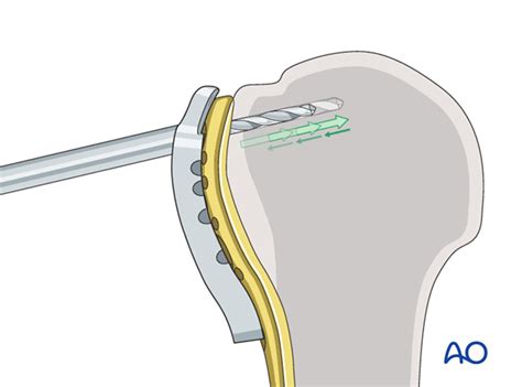 Orif Plate Fixation Proximal 1 3 For Multifragmentary Fracture Intact Segment