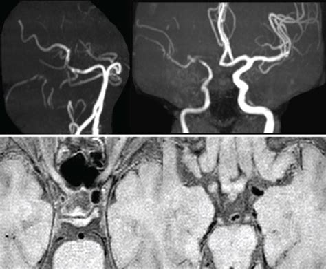 Pc Mra And Tof Mra For Different Cerebrovascular Stenosis Download