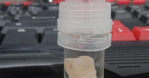 Wisdom Tooth Imgur Wisdom Tooth Imgur