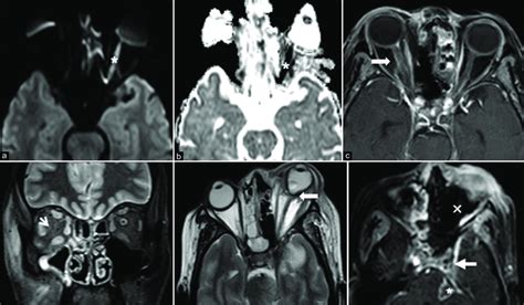 A And B Dwi A And Adc Map B Diffusion Restriction In Left Optic