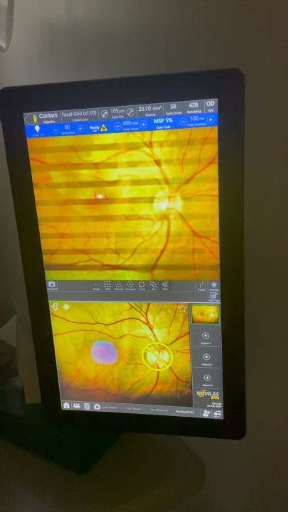 Mohammad Alhazzazi Bsc Md On Linkedin Micropulse Laser For Chronic Csr