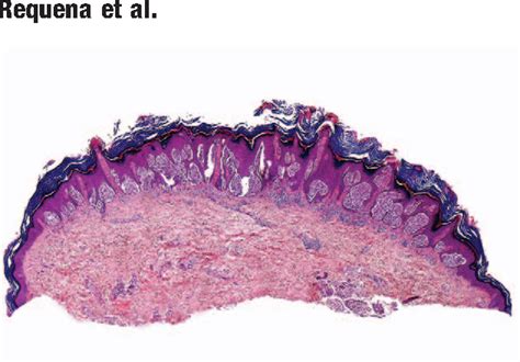 Pigmented Spindle Cell Nevus Semantic Scholar