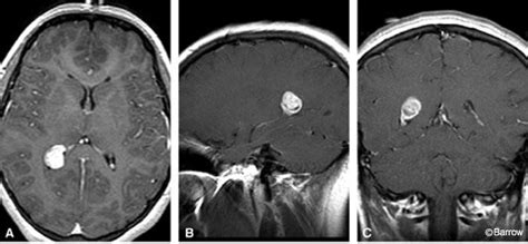 Lateral Ventricle Neoplasm With Skeletal Muscle Differentiation