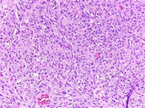 Pathology Outlines Sarcomatoid Variant