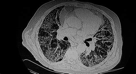 New Esc Guideline Has Adapted Recommendations Medizinonline