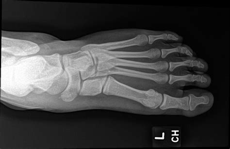 Orthodx Tarsal Navicular Fracture Clinical Advisor