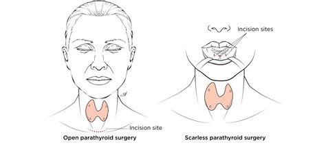 Scarless Thyroid And Parathyroid Surgery Baylor Medicine