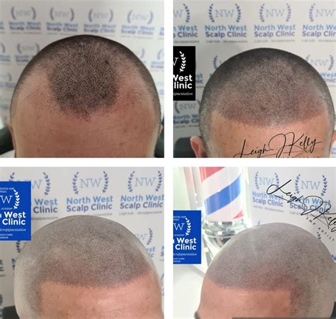 Gallery - North West Scalp Clinic