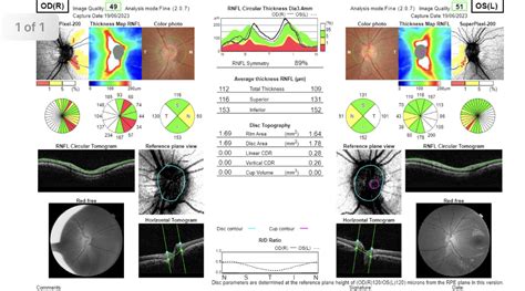 19m Oct Scan Anything Concerning R Askglaucoma