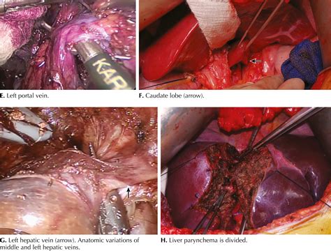 Hepatectomy Clinical Tree