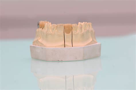 Excel Dental Lab Crown And Bridge Laboratory With Iso 9001 2008 In Thailand Asia