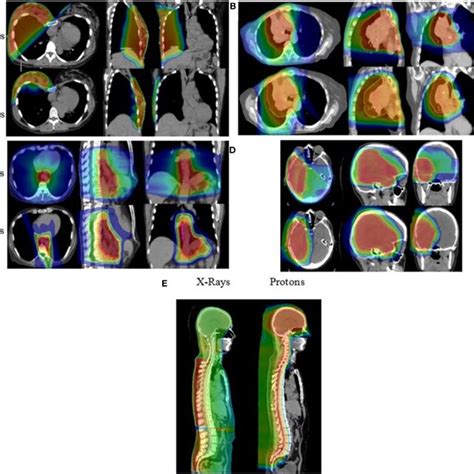 Mevion S250i Proton Therapy System With Hyperscan Pencil Beam Scanning