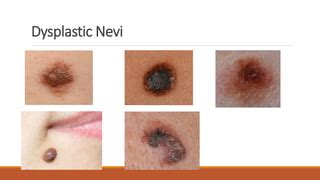 Dysplastic And Melanocytic Naevi Pptx