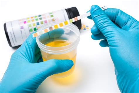 Sample Urinalysis Uti