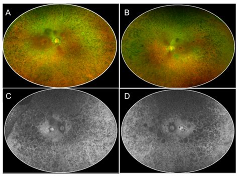 Retinal Imaging Findings In Inherited Retinal Diseases