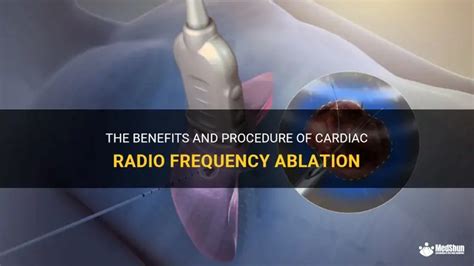 The Benefits And Procedure Of Cardiac Radio Frequency Ablation Medshun