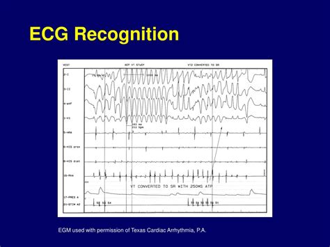 Ppt Ventricular Tachyarrhythmias Powerpoint Presentation Free