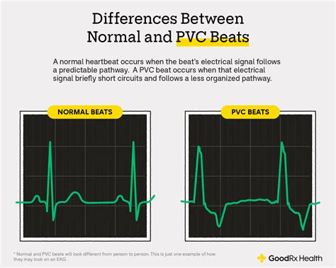 Pvc Contraction Premature Ventricular Contraction Multiple Vs