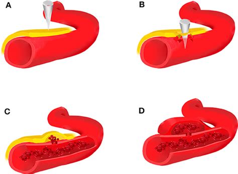 Frontiers Intracranial Pseudoaneurysms Evaluation And Management