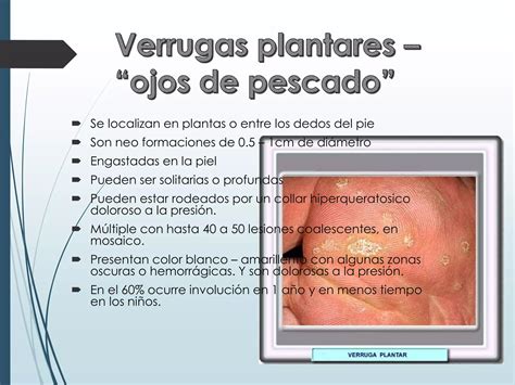 Verrugas Virales Ppt