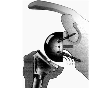 Notching Classification According To Sirveaux Et Al [2] And Nerot Et Download Scientific