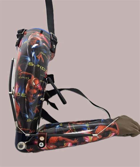 Here Is Another Pediatric Device We Fabricated This Is A Body Powered