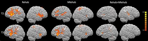 Early Aphasia Rehabilitation Is Associated With Functional Reactivation Of The Left Inferior