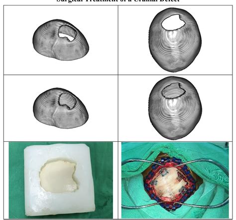 Clinical Cranial Reconstruction The First Row Shows The