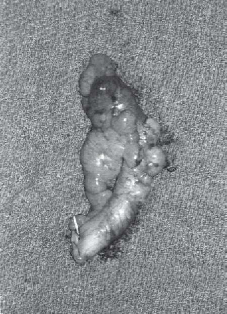 Figure 1 From Diverticulosis Of The Appendix Semantic Scholar