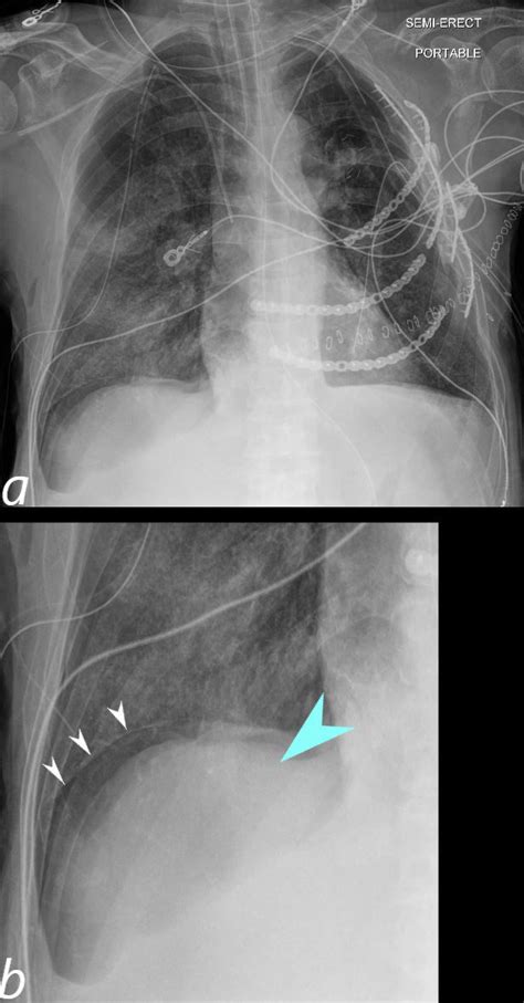 Vg If Lung Deep Sulcus Sign Pneumothorax Cxr The Common Vein