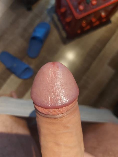 Rash Itchy Inside Penis Rbalanitis