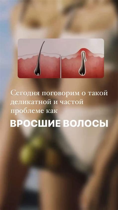 Вросшие волосы | Эпиляция, Косметология, Лазерная эпиляция