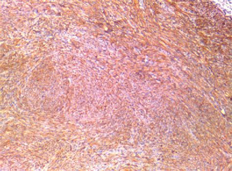 Immunohistochemical Findings Of The Case Of Angioleiomyoma Reported
