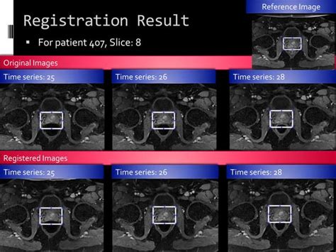 Post Processing Of Prostate Perfusion Mri Pptx Medical Tests