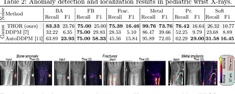 Diffusion Models With Implicit Guidance For Medical Anomaly Detection