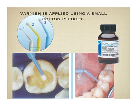 Dental Bases And Liners Pdf