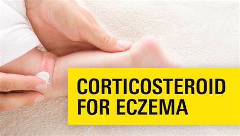 Choosing The Right Corticosteroid For Your Eczema