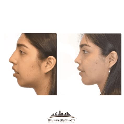 Jaw Repositioning Orthognathic Surgery Dallas Surgical Arts