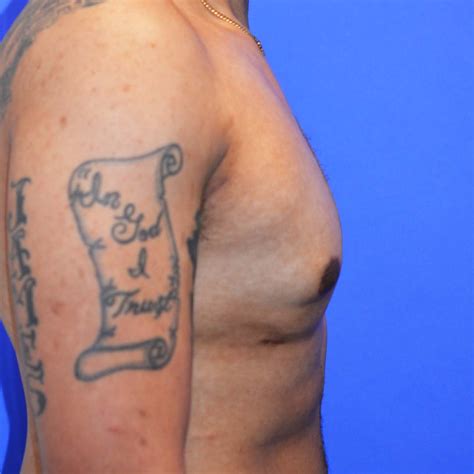 Gynecomastia Case 2 Wellspring Plastic Surgery