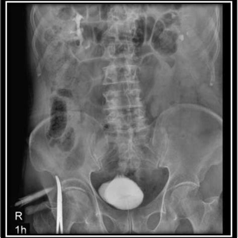Intravenous Pyelography Ivp 30 Minutes After Instilling The Download Scientific Diagram