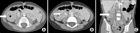 Figure 2 From A Case Of Intussusception With Acute Appendicitis Semantic Scholar