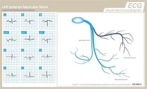 Anterior Fascicular Block Images Stock Photos D Objects Vectors Shutterstock
