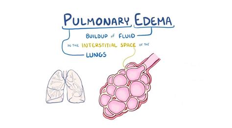 Pleural Effusion Vs Pulmonary Edema Medical Odyssey