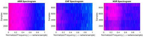 Deep-Learning-Based Arrhythmia Detection Using ECG Signals: A Comparative Study and Performance ...