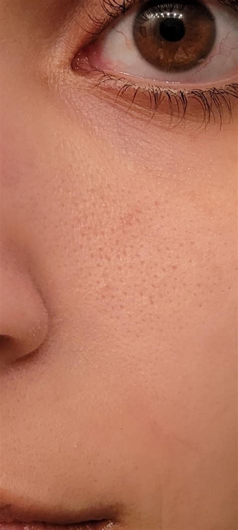 Weird Skin Texture R Dermatologyquestions