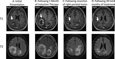 Soap Bubble Lesions Cryptococcus Neoformans In Brain
